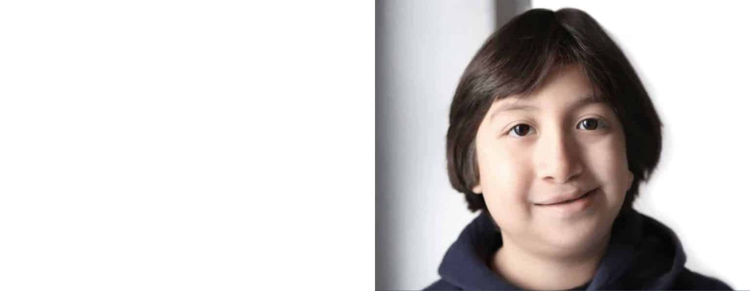 Cleidocranial Dysplasia (CCD)