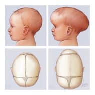 Craniosynostosis - Craniofacial Conditions